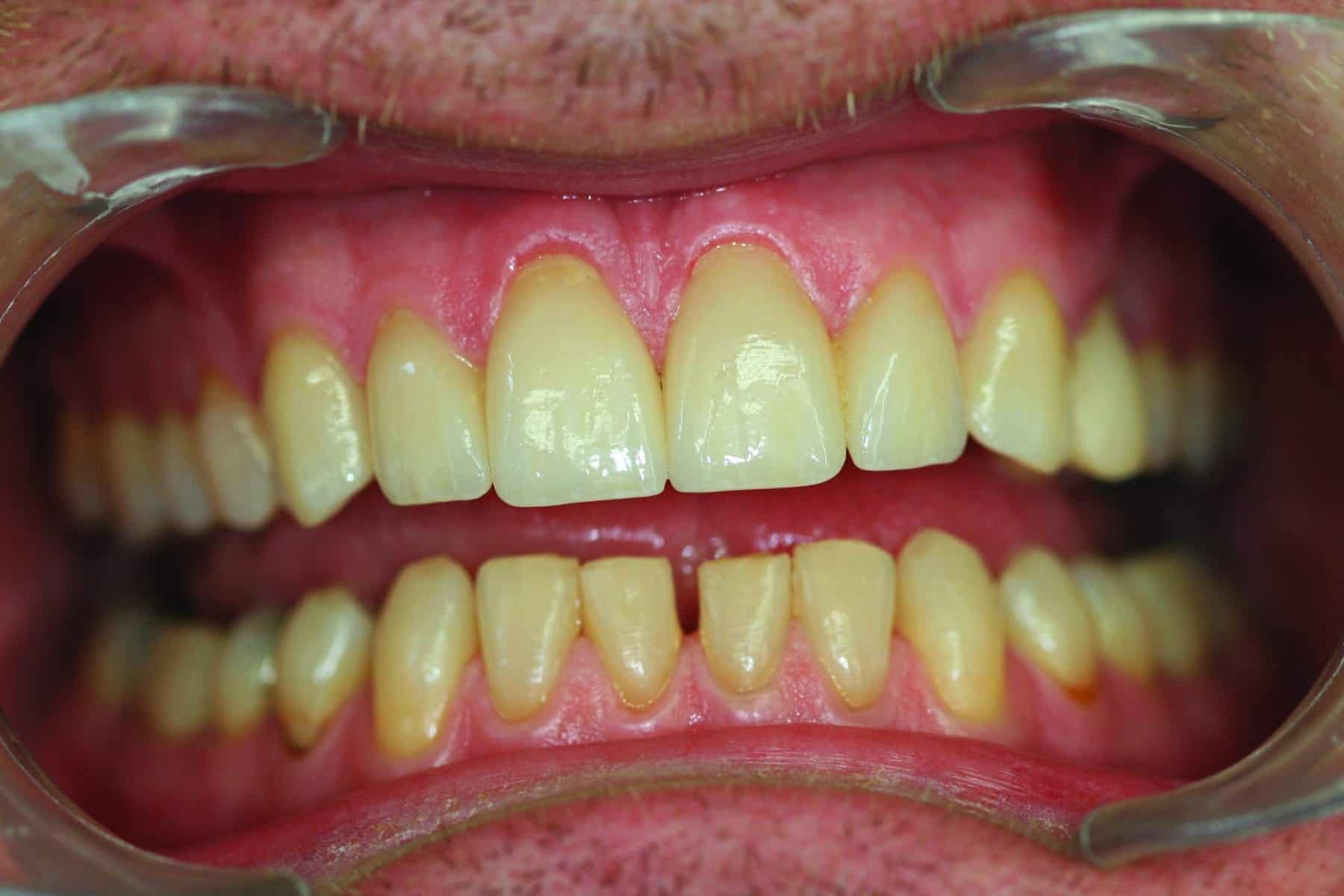 Ny tann på timen - Byavisa Drammen